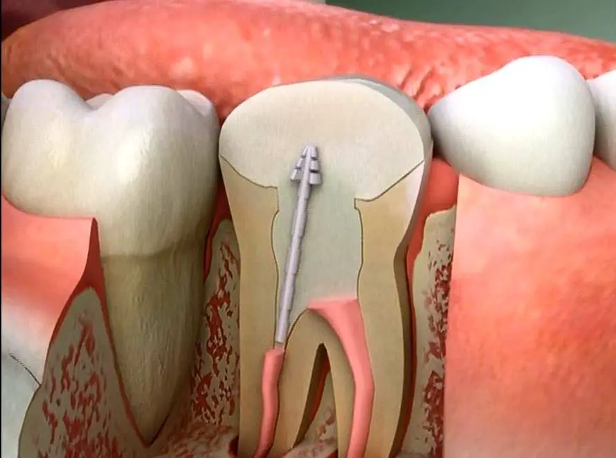 Signs That You Need A Root Canal Treatment DentalsReview Signs That You Need A Root Canal Treatment DentalsReview
