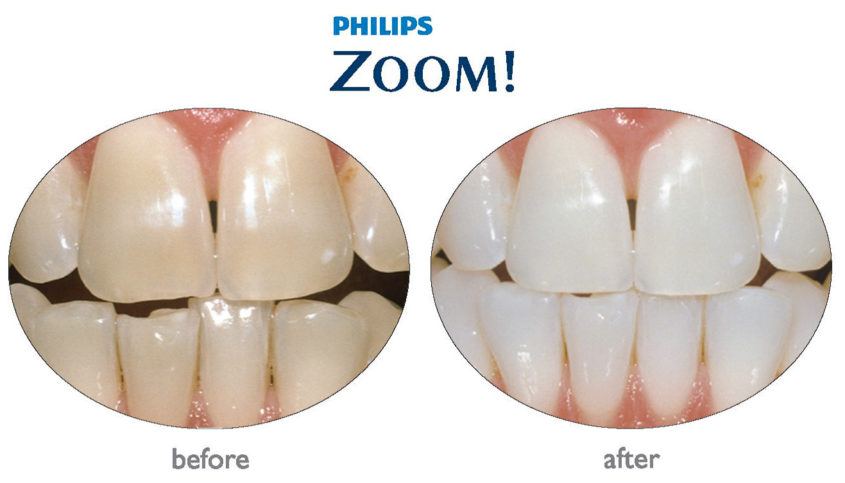 All About Zoom Whitening - Review 2021 - Cost, Side Effects, Before and ...