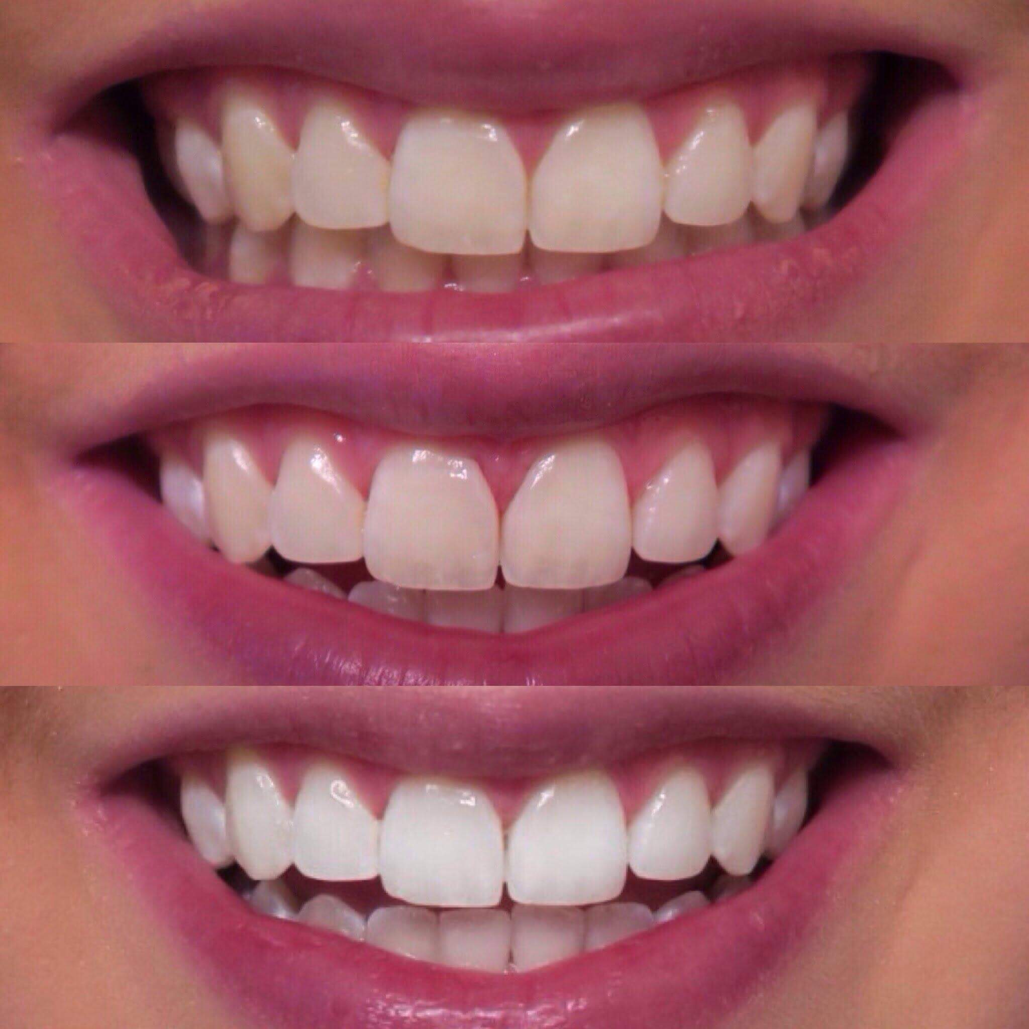 The Best Whitening Toothpaste - Reviews Based On Consumer Reports 2021 ...