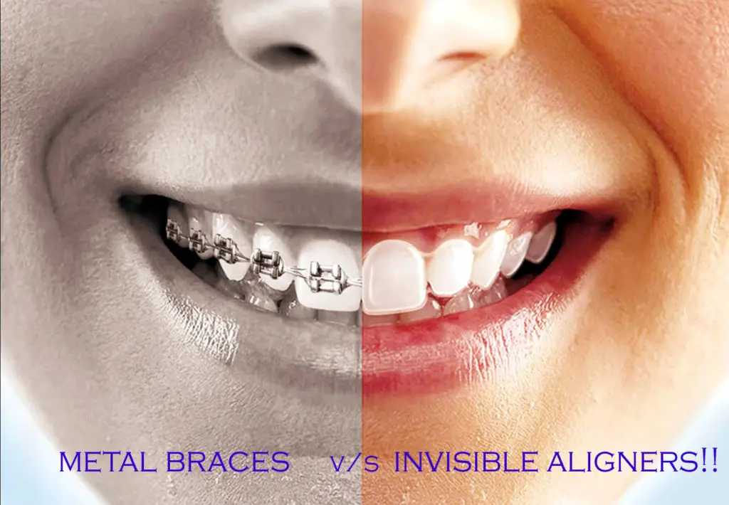 Clear Braces vs. Invisible Aligners—What’s the Difference? - DentalsReview