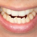 Why Teeth Buzz: Exploring the Causes and Solutions for Vibrating Teeth ...