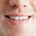 Why Do Some Kids Develop Silver Teeth? Understanding the Causes and ...