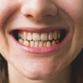 Clicking Teeth: What Causes It and How to Fix It - DentalsReview
