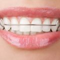 Clicking Teeth: What Causes It and How to Fix It - DentalsReview